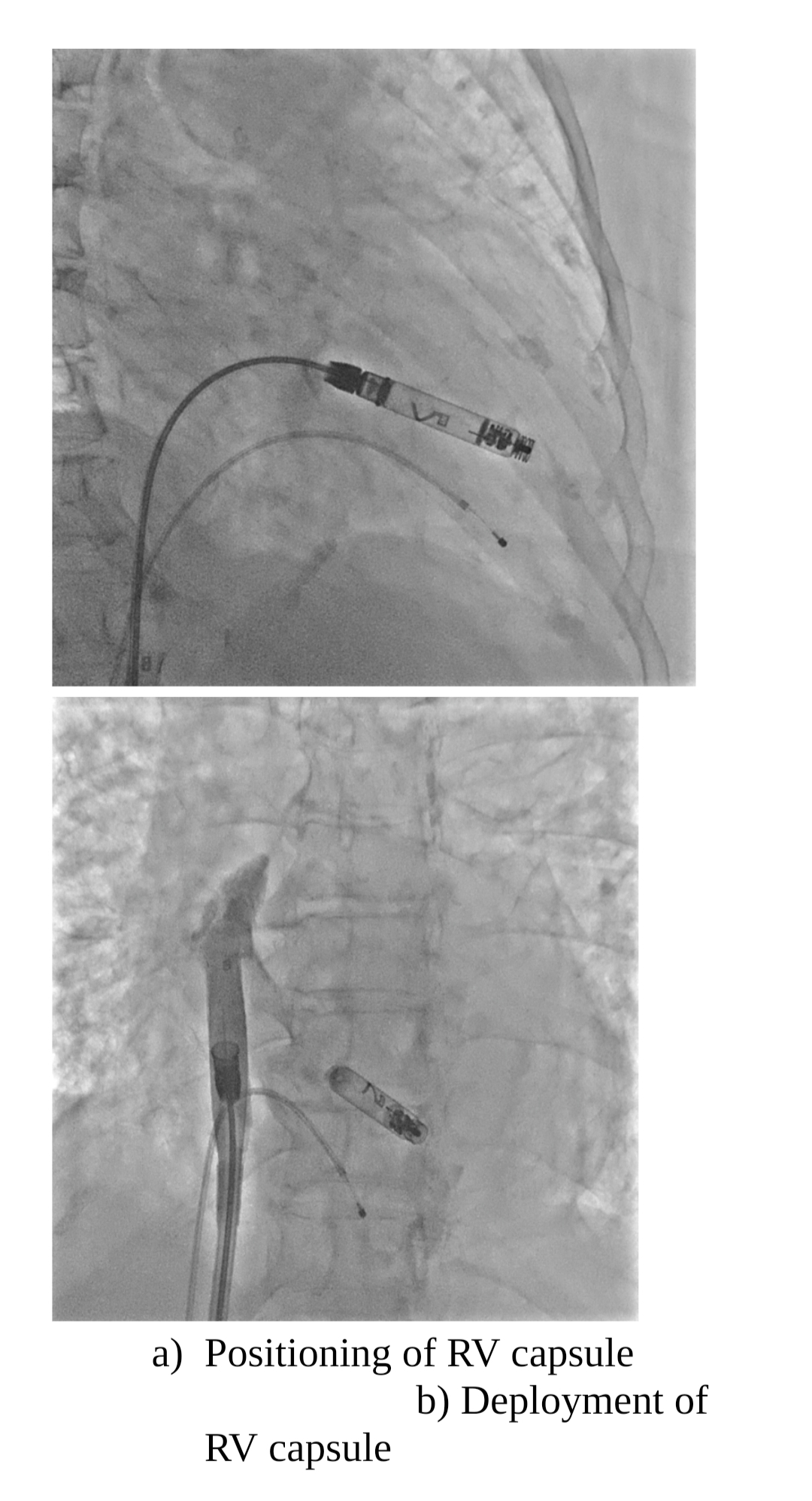 A New Era in Cardiac Pacing: Lead to Leadless- Implantation of the ...