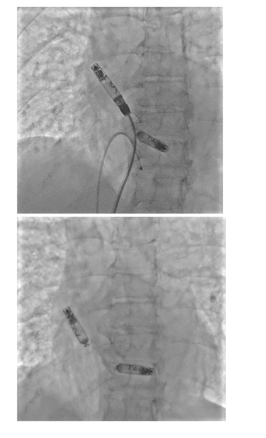 A New Era in Cardiac Pacing: Lead to Leadless- Implantation of the ...